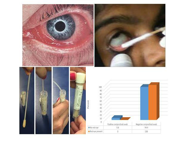 Culture & Sensitivity - Conjunctival Swab | RT Diagnostics