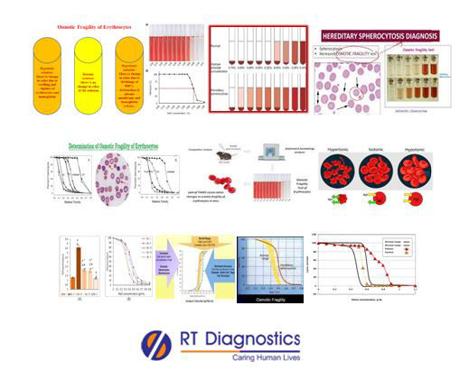 Osmotic Fragility (Rbc) | RT Diagnostics